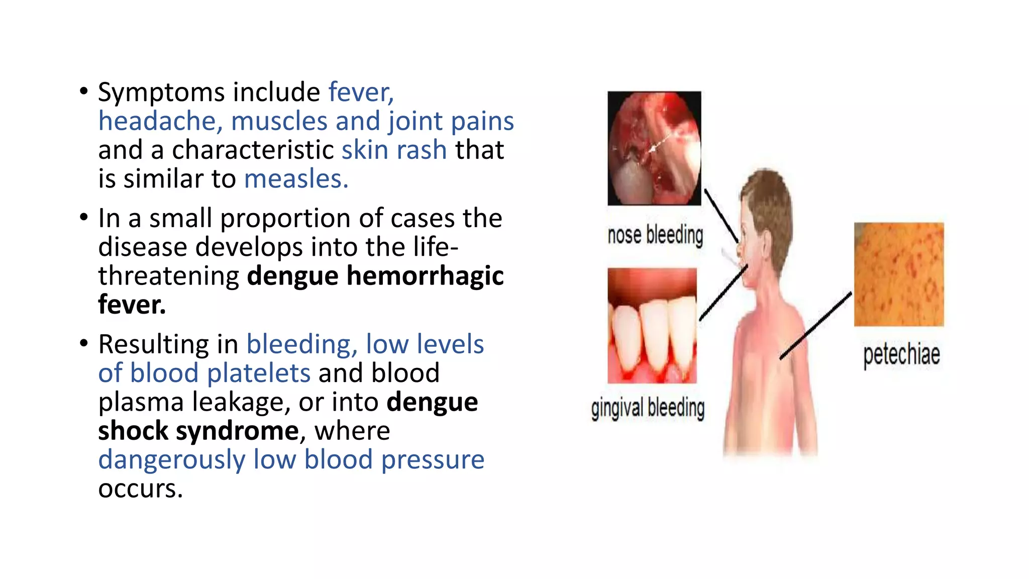 Dengue, DHF, DSS, prevention, prognosis and its management | PPTX