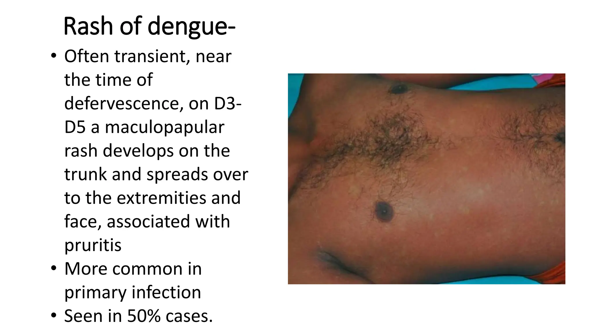 DENGUE - classification, symptoms and treatment | PPTX