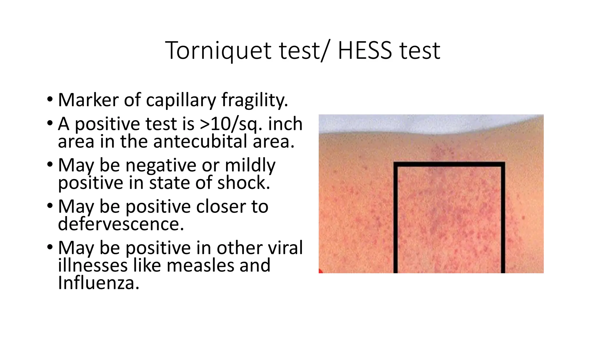 DENGUE - classification, symptoms and treatment | PPTX