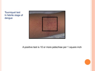 Dengue and chikungunya in Children | PPTX