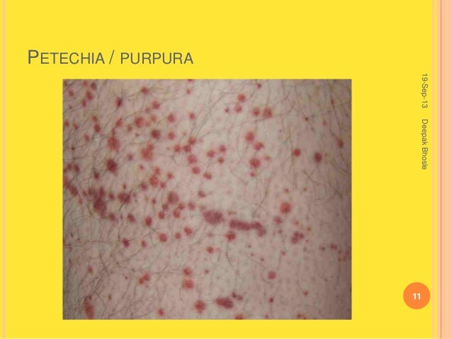 Dengue fever- clinical features,investigations, diagnosis, treatment