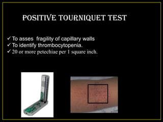 Dengue fever.. intro | PPT