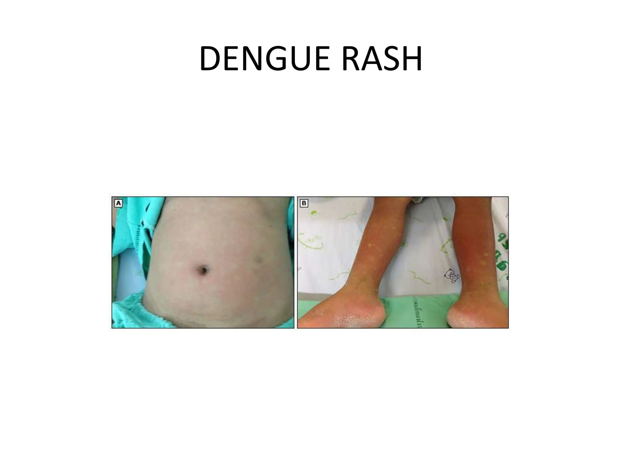 DENGUE FEVER BY DR.RADHE.pptx CIVIL HOSPITAL NEPAL | PPTX