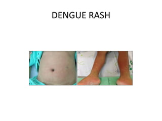 DENGUE FEVER BY DR.RADHE.pptx CIVIL HOSPITAL NEPAL | PPTX