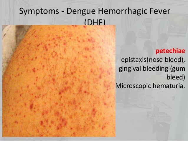 Dengue and Dengue Hemorrhagic Fever