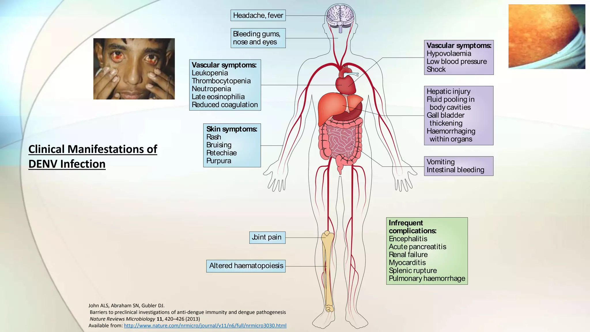 Dengue fever Epidemiology - pathogenesis - symptoms - diagnosis ...