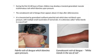 Dengue _Dengue_Dengue _Dengue_Dengue _Dengue_ | PPTX
