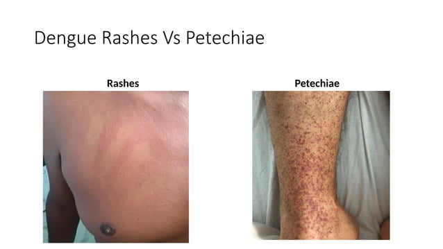 DENGUE MANAGEMENT- AS PER LATEST WHO GUIDELINES | PPTX