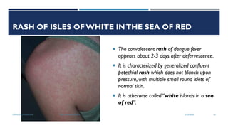 Dengue Syndrome (Dengue Fever, Dengue Haemorrhagic Fever & Dengue Shock ...