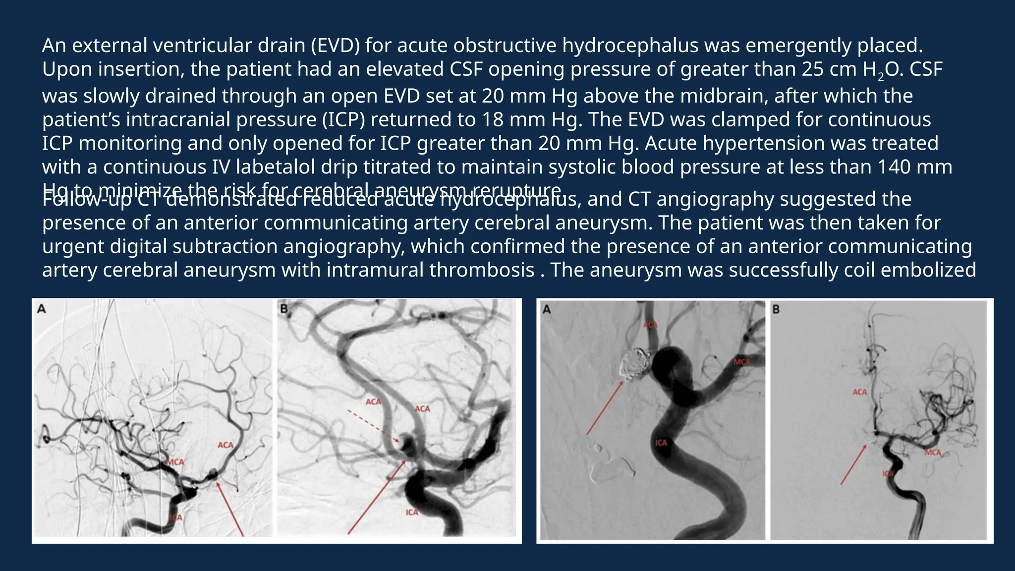 Subarachnoid Hemorrhage, Management and treatment | PPTX