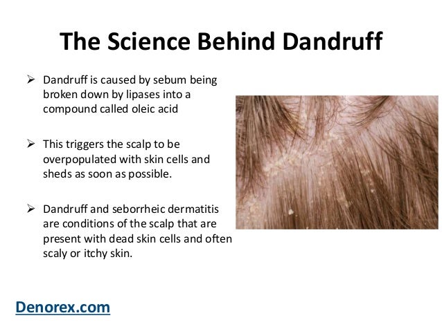 What Is Dandruff?