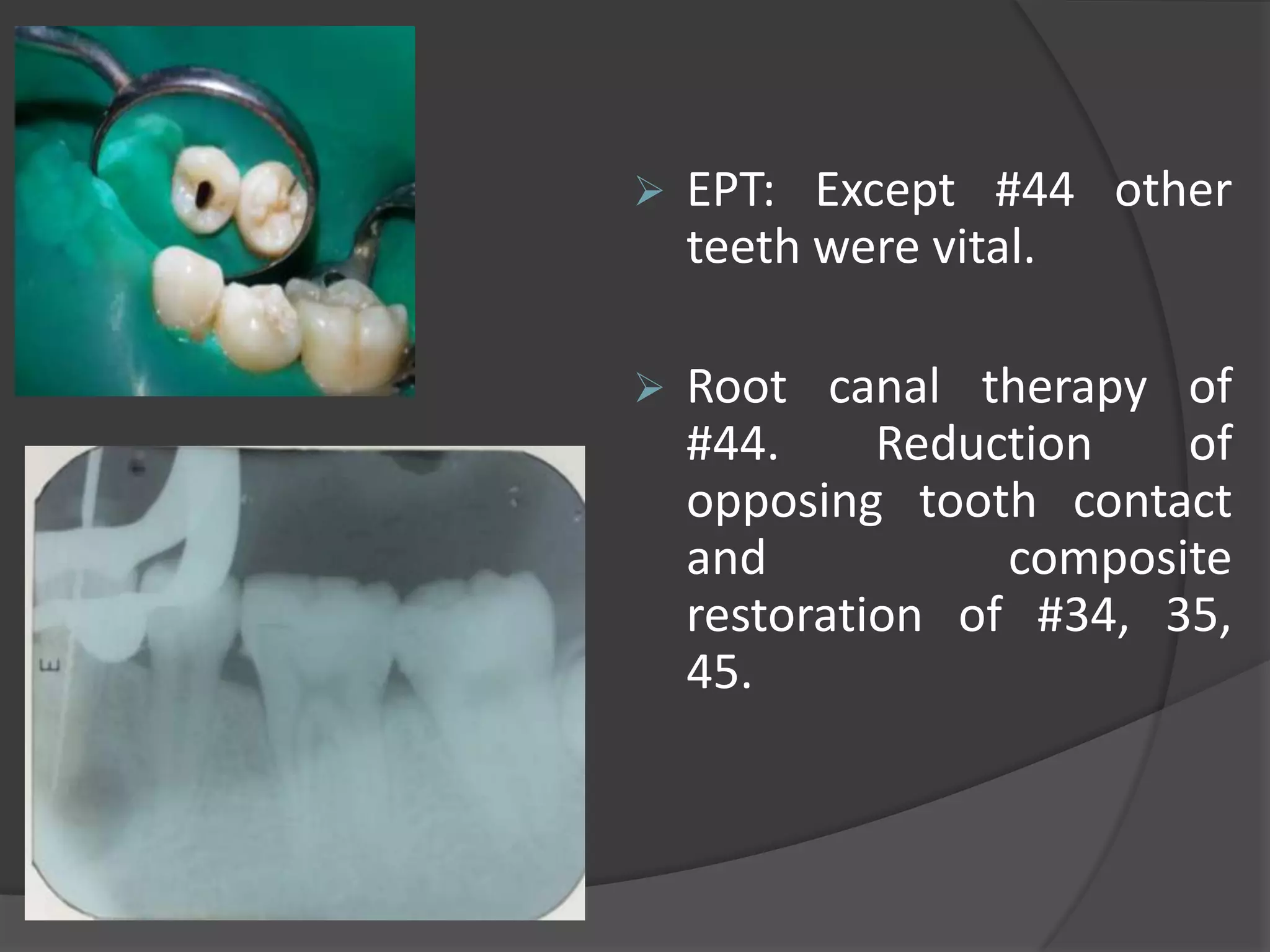 Dens evaginatus | PPTX