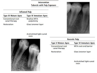 Dens evaginatus | PPTX