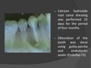 Dens evaginatus | PPTX