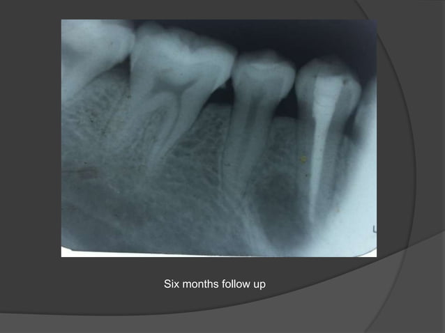 Dens evaginatus | PPTX | Dental Health | Diseases and Conditions