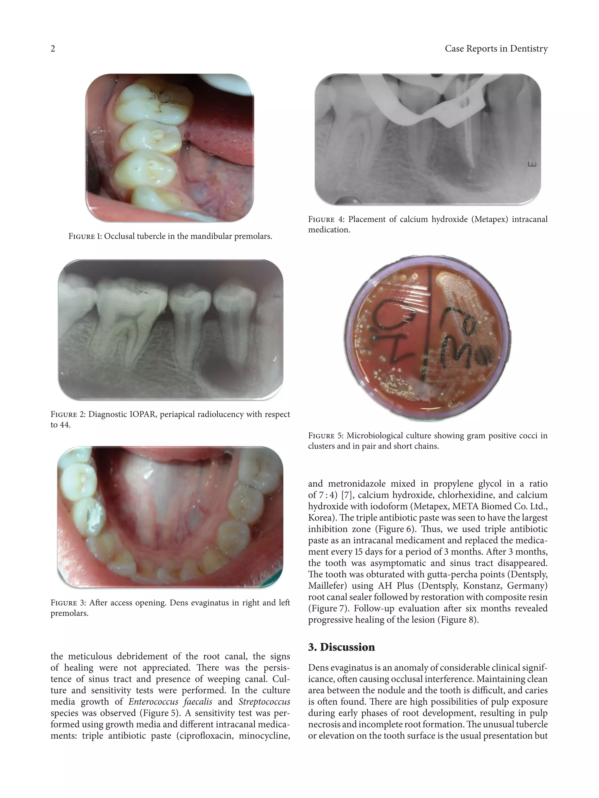 Dens evaginatus- a problem based approach | PDF