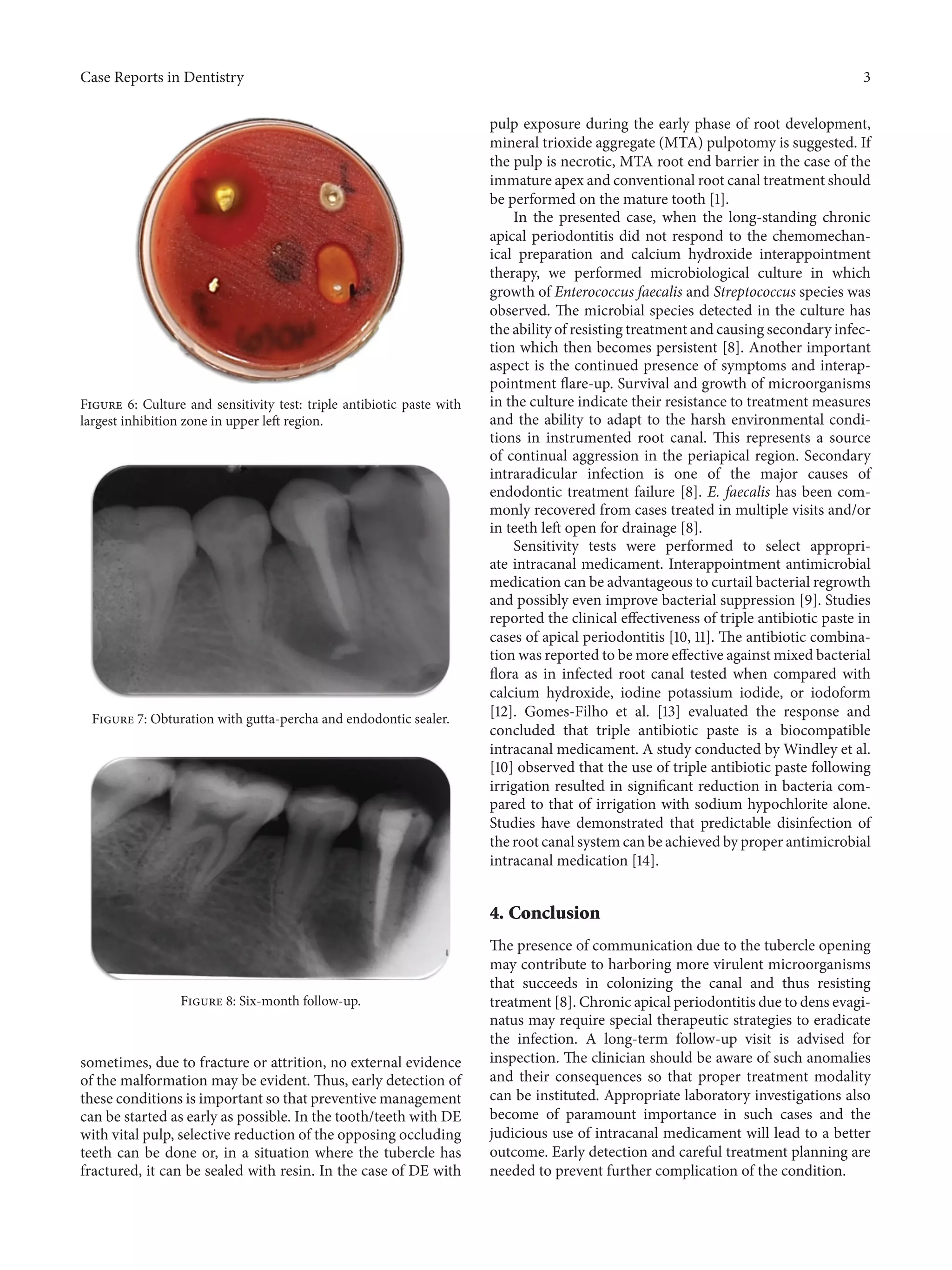 Dens evaginatus- a problem based approach | PDF