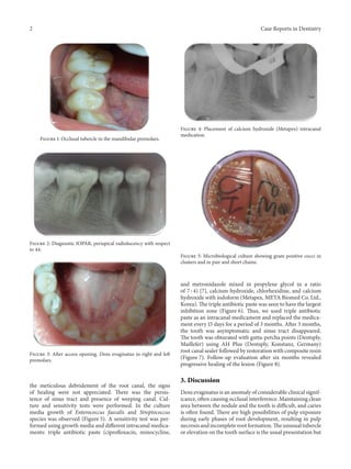 Dens evaginatus- a problem based approach | PDF