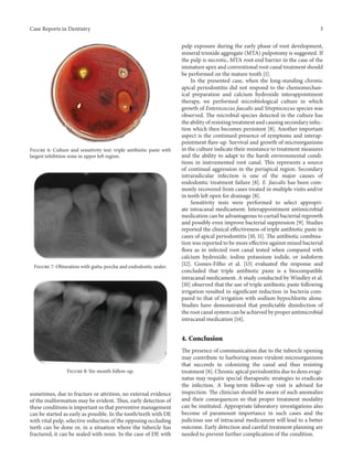 Dens evaginatus- a problem based approach | PDF