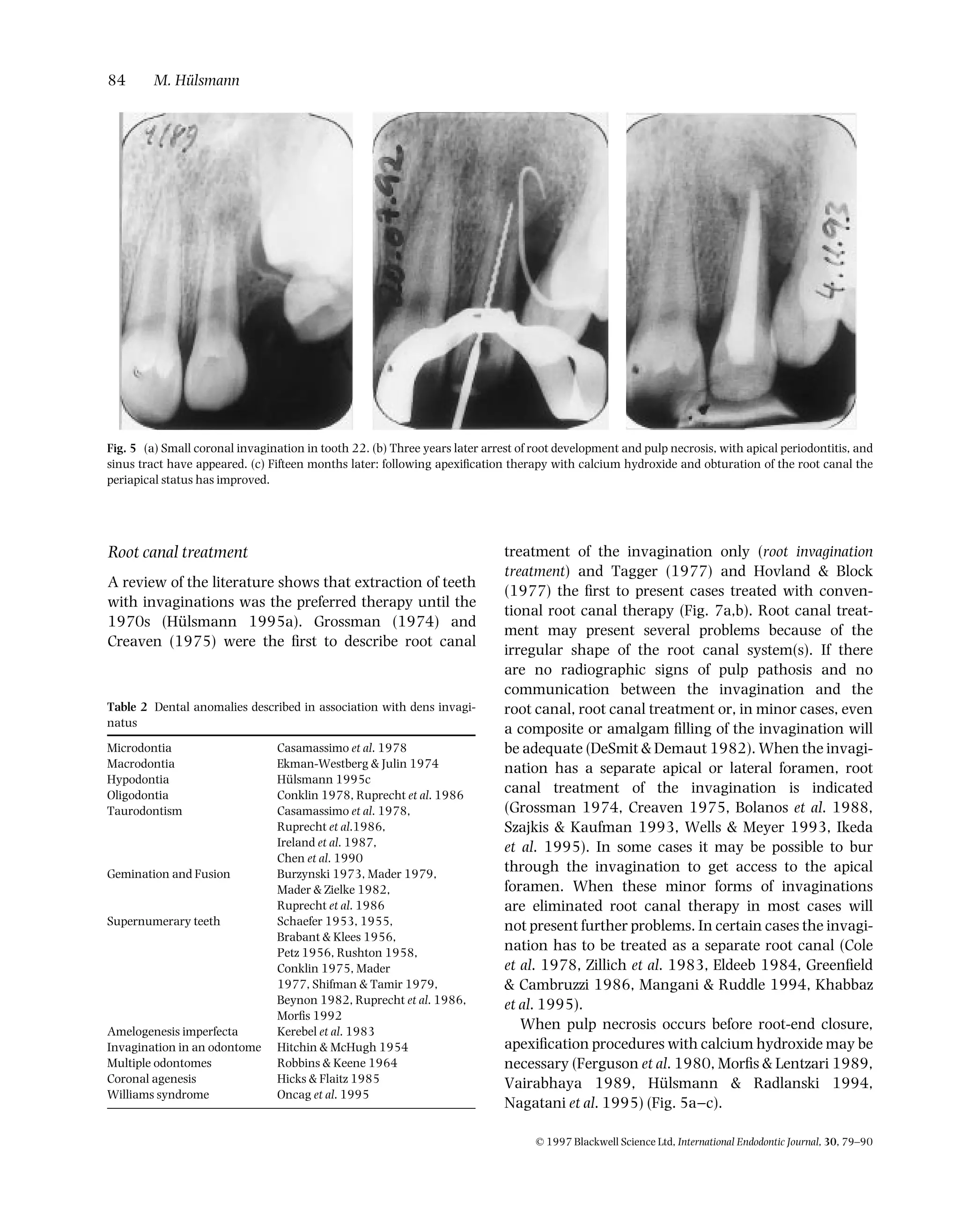 Dens invaginatus | PDF