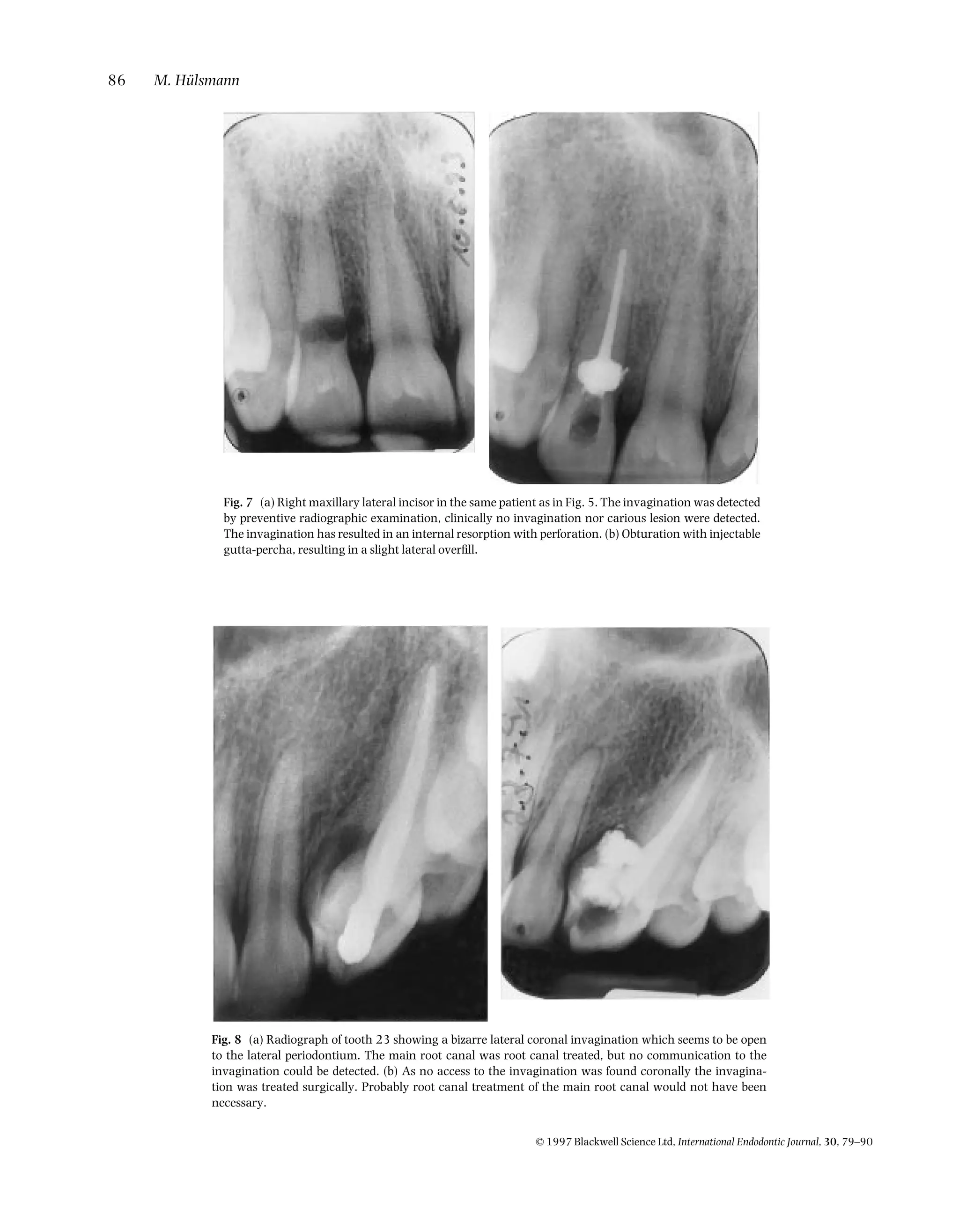 Dens invaginatus | PDF