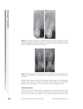 Dens invaginatus part 2 | PDF