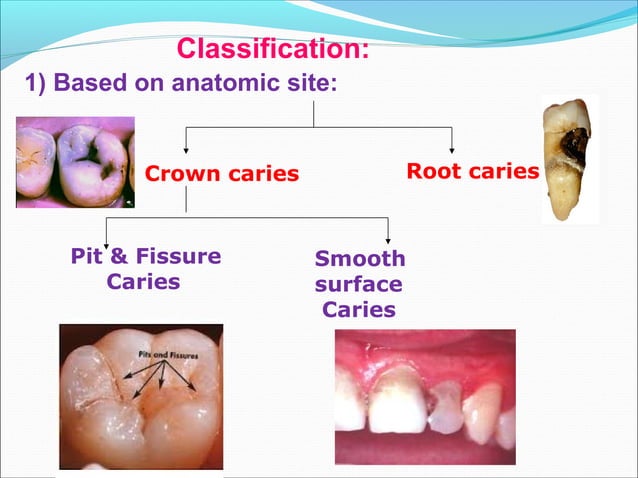 Dental caries | PPT