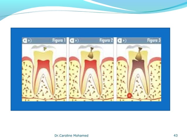Dental caries | PPT