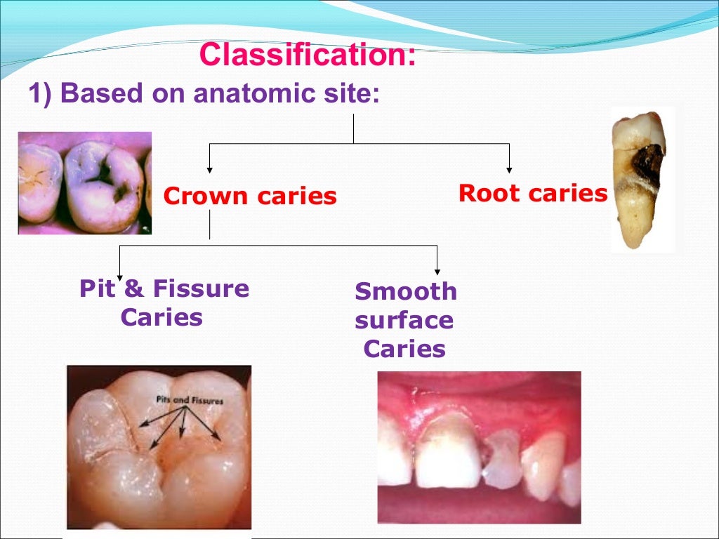 Dental caries