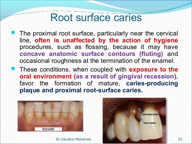 Dental caries
