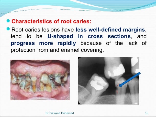Dental caries