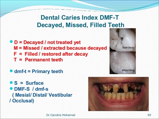 Dental caries