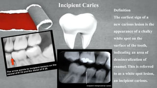 powerpoint presentation about dental caries | PPTX