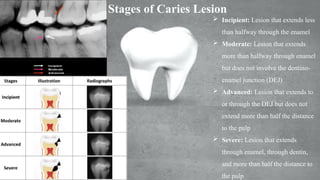 powerpoint presentation about dental caries | PPTX