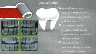 powerpoint presentation about dental caries | PPTX