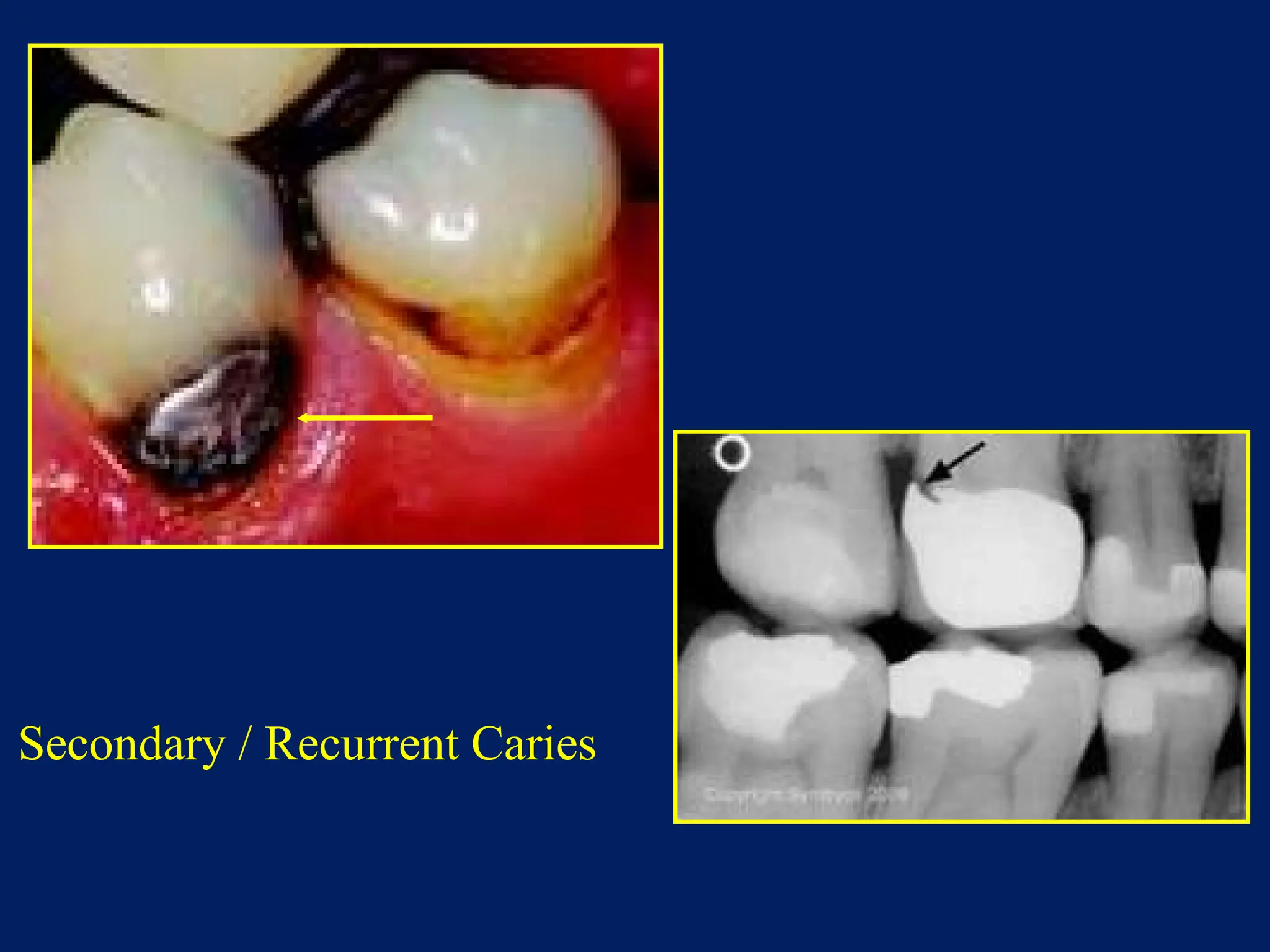This 'Dental Caries PPT' is a presentation template specialized for ...