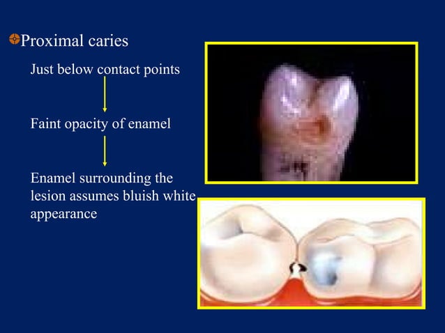 This 'Dental Caries PPT' is a presentation template specialized for ...