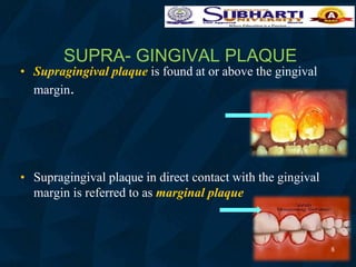 Dental-Plaque-1-202110221511350.pptx | Dental Health | Diseases and ...