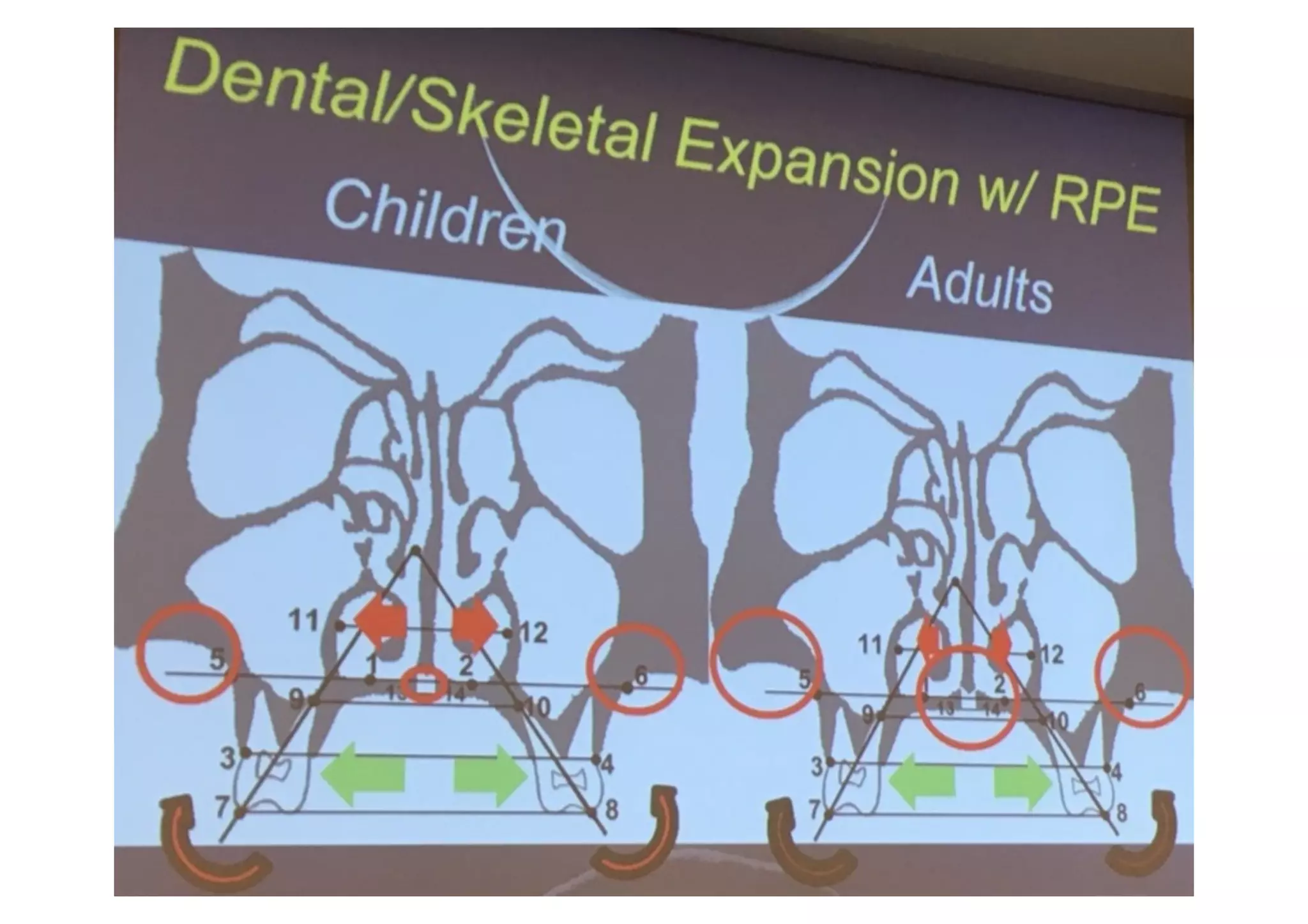 Non-Surgical Mid-Facial Expansion with Micro-Implant Assisted Maxillary ...