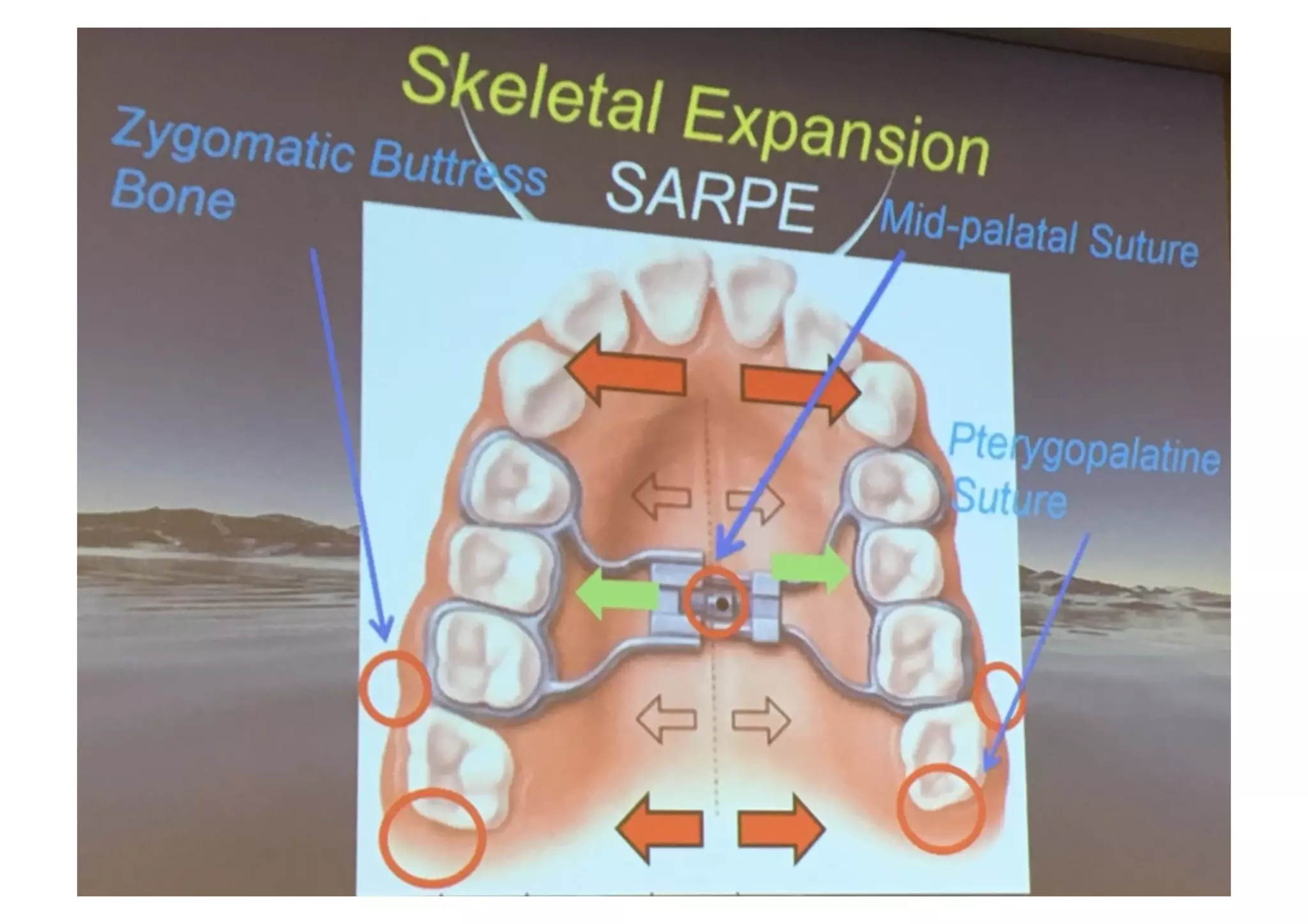 Non-Surgical Mid-Facial Expansion with Micro-Implant Assisted Maxillary ...