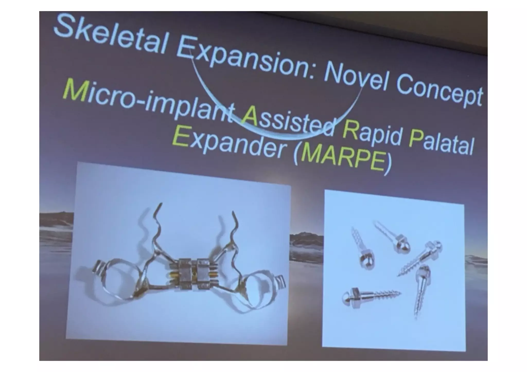 Non-Surgical Mid-Facial Expansion with Micro-Implant Assisted Maxillary ...