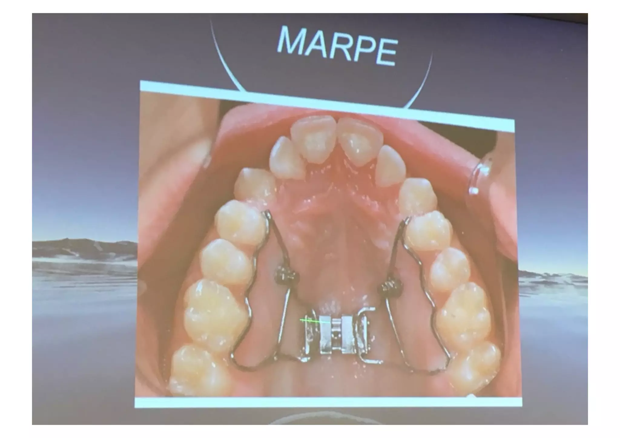 Non-Surgical Mid-Facial Expansion with Micro-Implant Assisted Maxillary ...