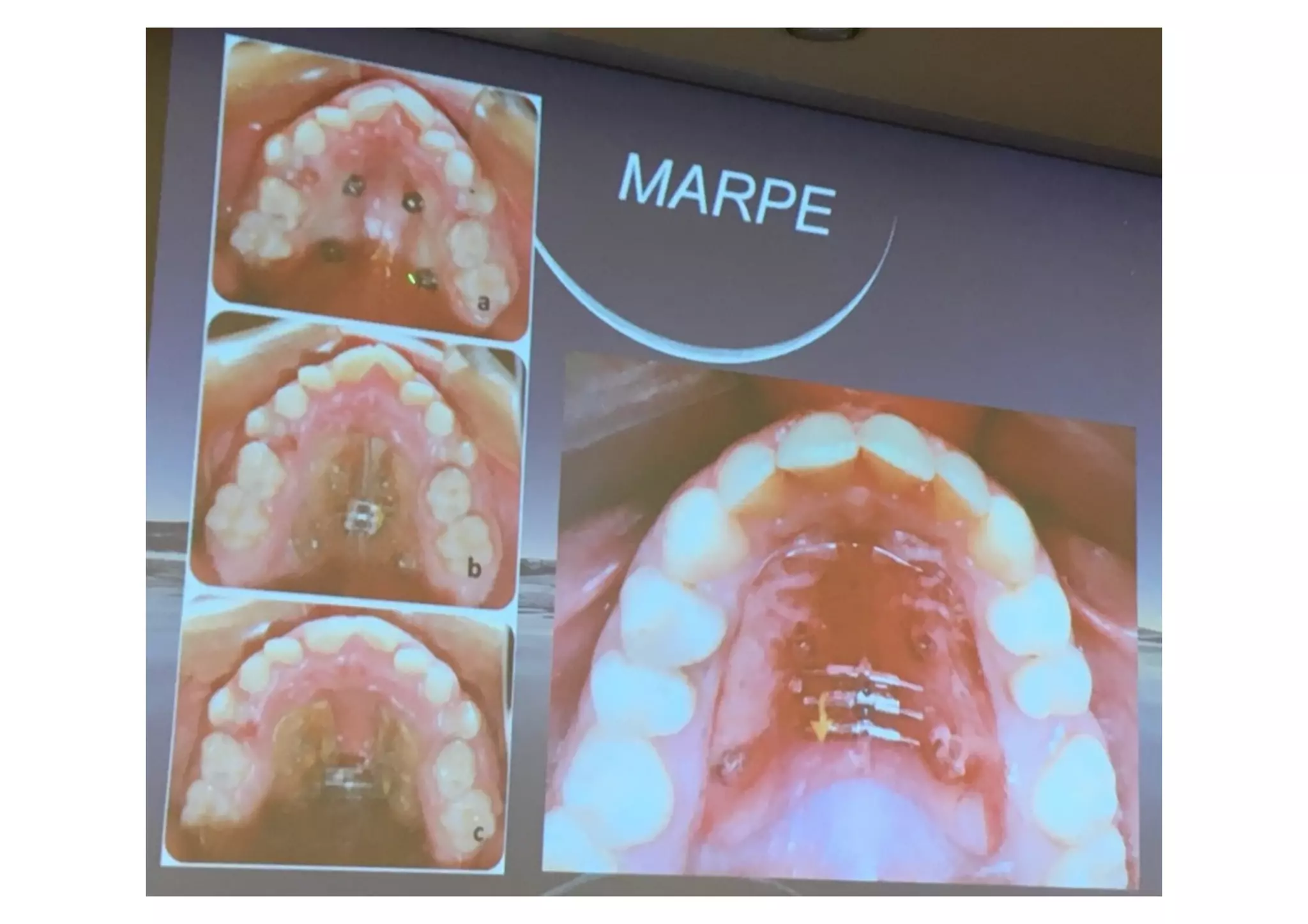 Non-Surgical Mid-Facial Expansion with Micro-Implant Assisted Maxillary ...