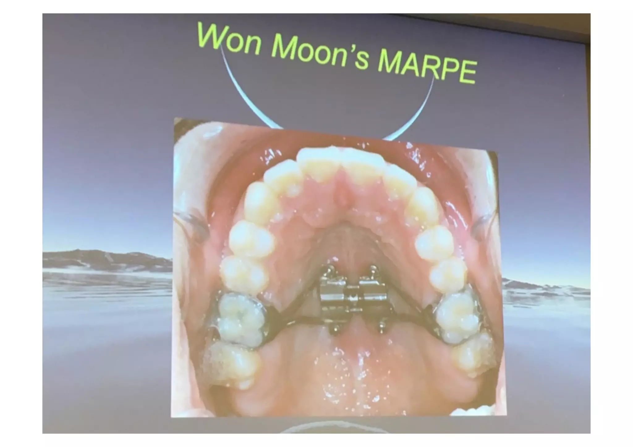 Non-Surgical Mid-Facial Expansion with Micro-Implant Assisted Maxillary ...