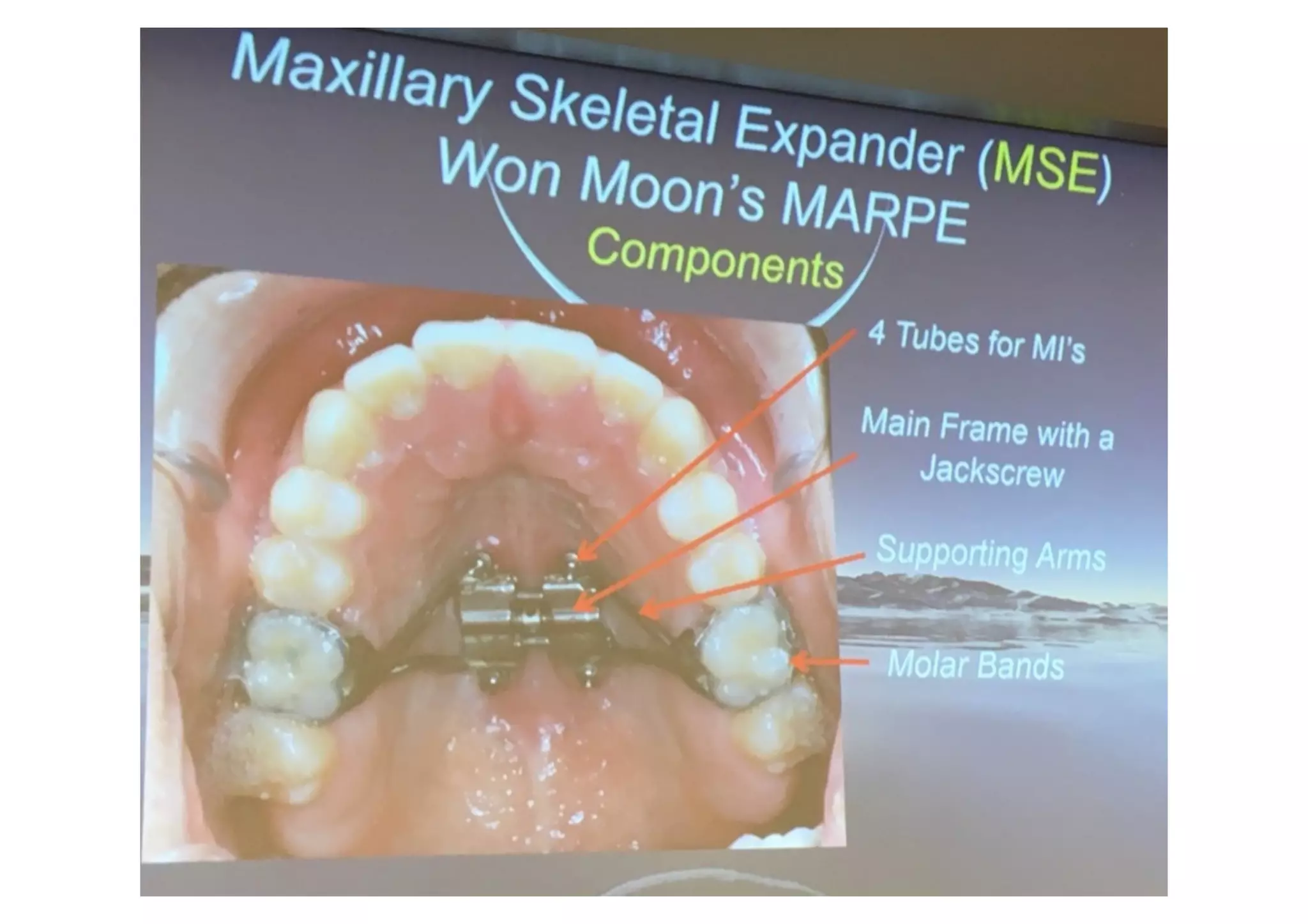 Non-Surgical Mid-Facial Expansion with Micro-Implant Assisted Maxillary ...