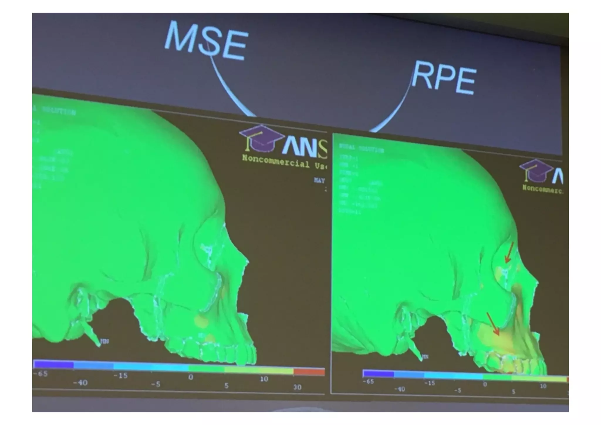 Non-Surgical Mid-Facial Expansion with Micro-Implant Assisted Maxillary ...