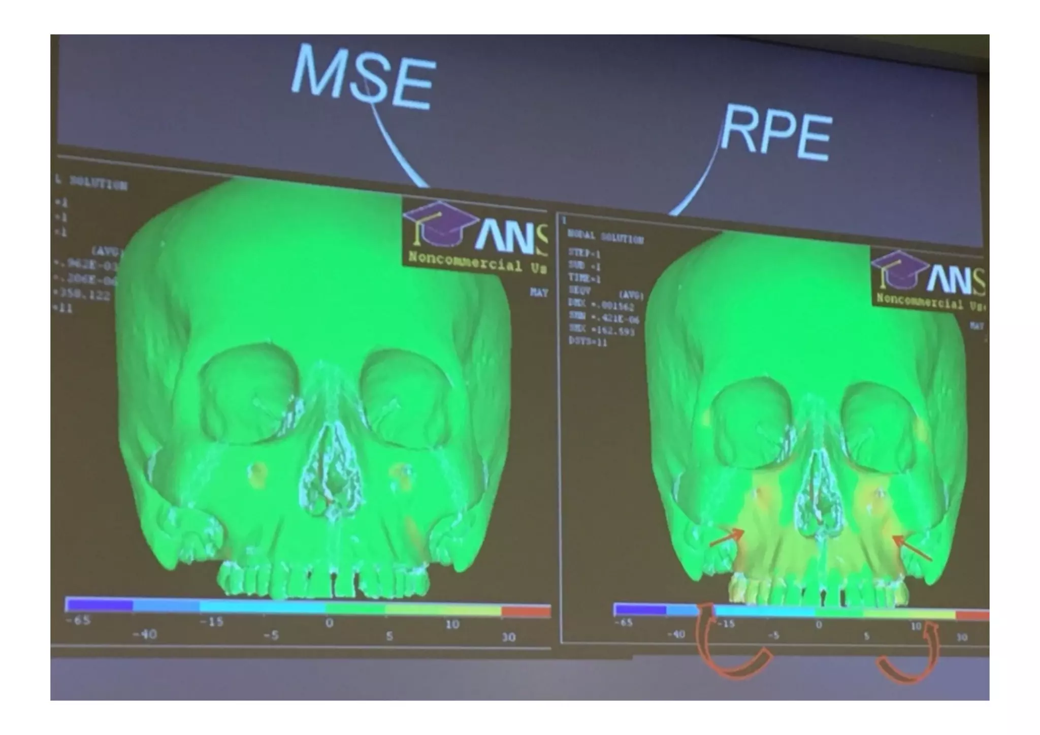 Non-Surgical Mid-Facial Expansion with Micro-Implant Assisted Maxillary ...