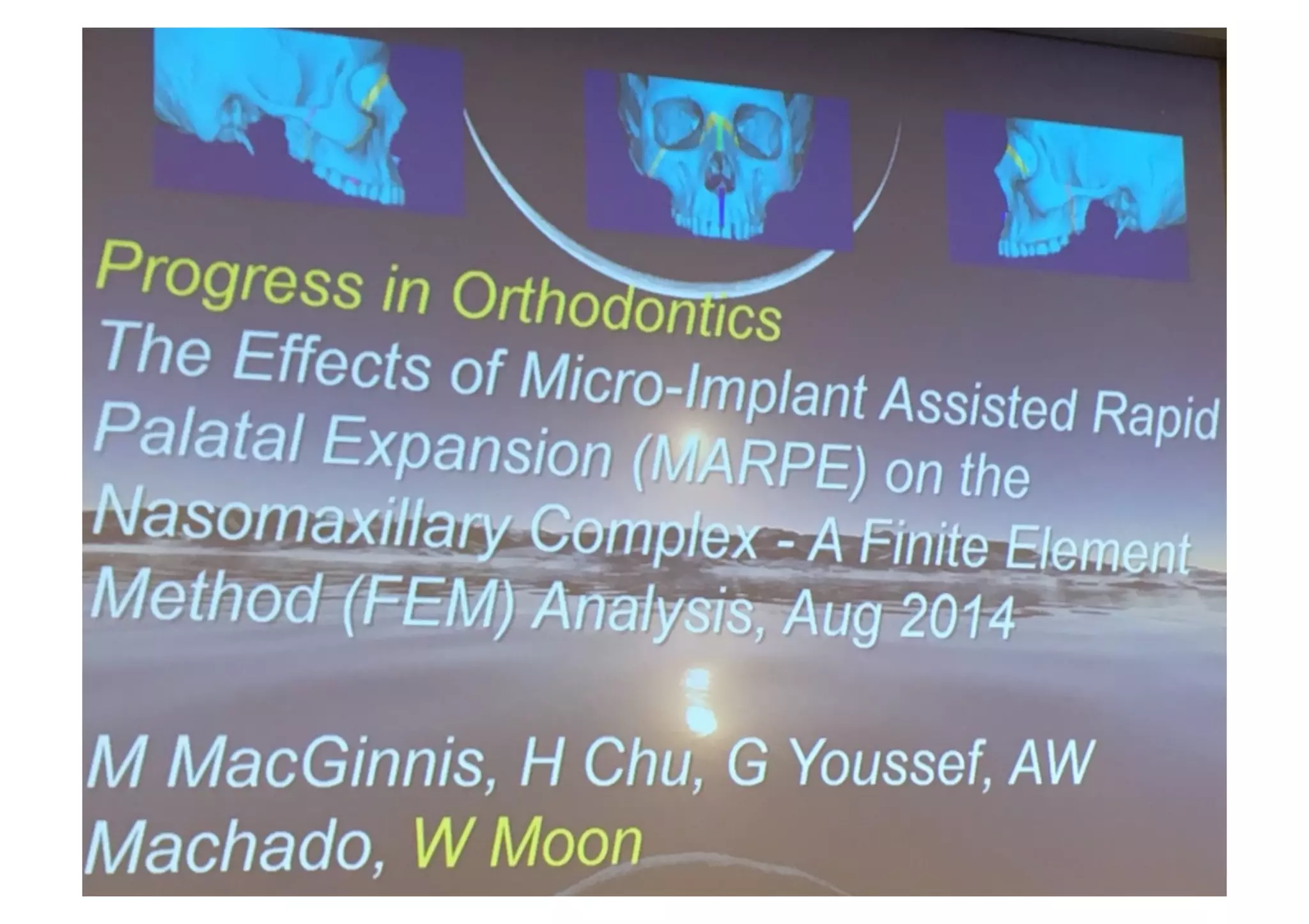 Non-Surgical Mid-Facial Expansion with Micro-Implant Assisted Maxillary ...