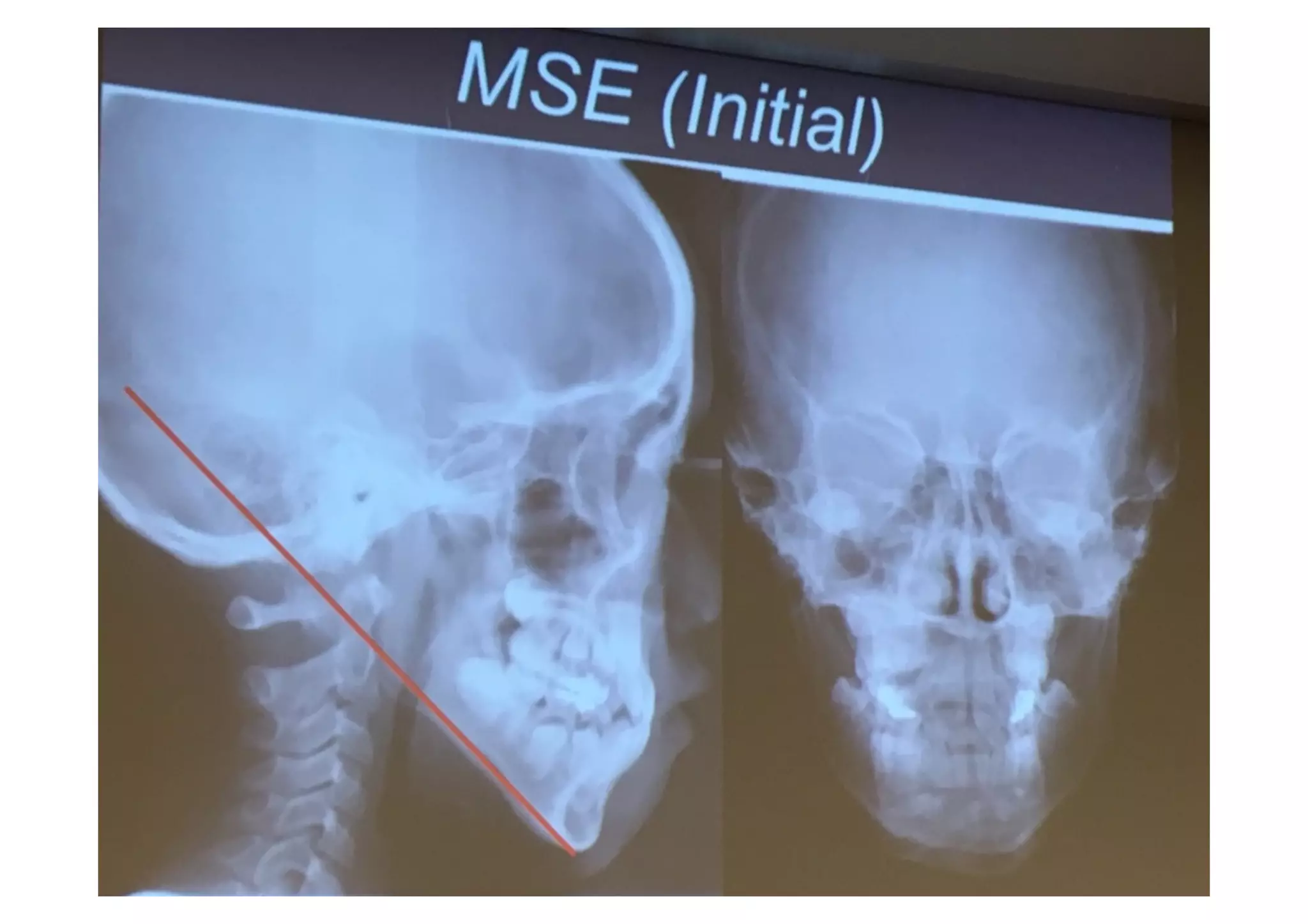 Non-Surgical Mid-Facial Expansion with Micro-Implant Assisted Maxillary ...