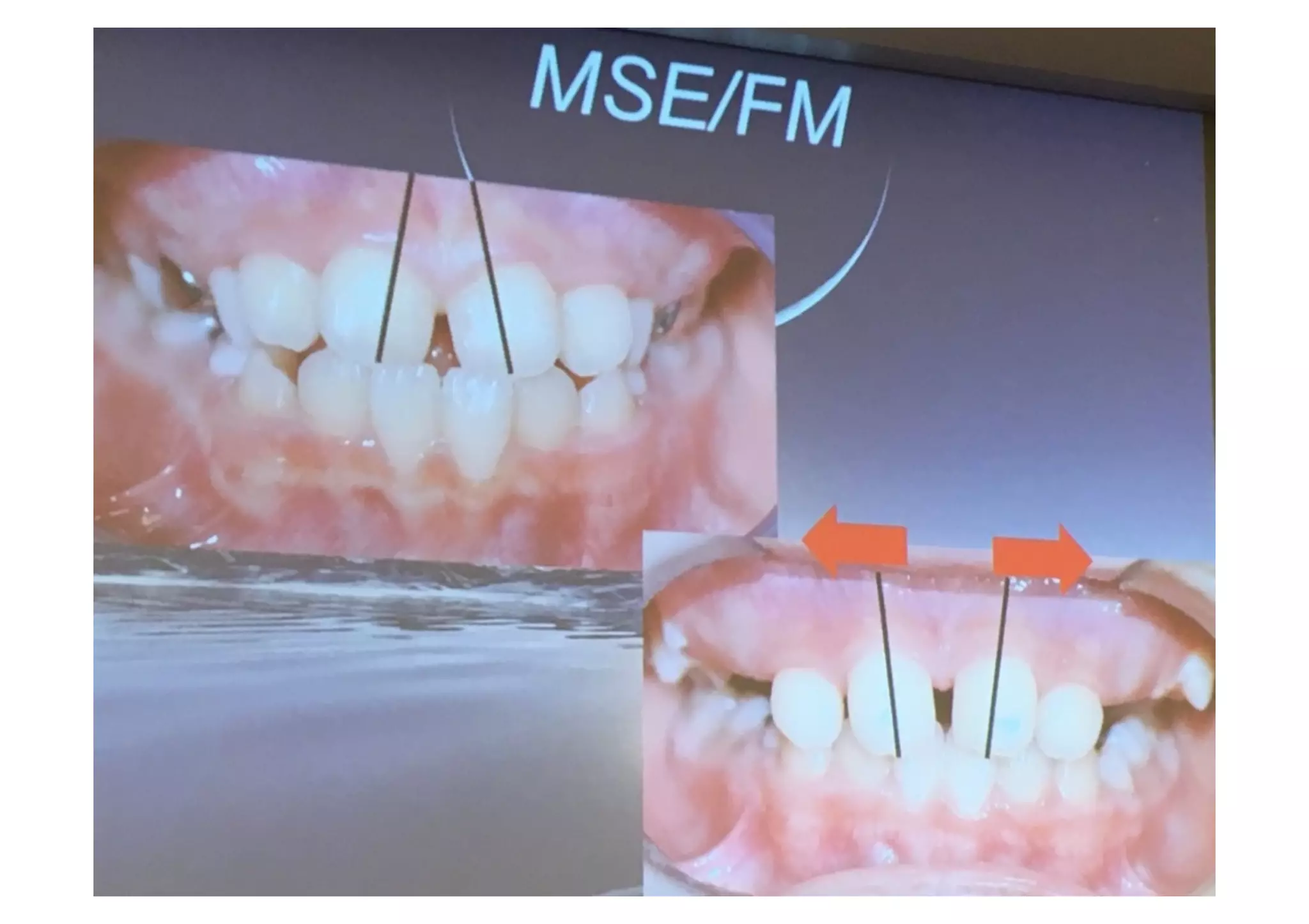 Non-Surgical Mid-Facial Expansion with Micro-Implant Assisted Maxillary ...